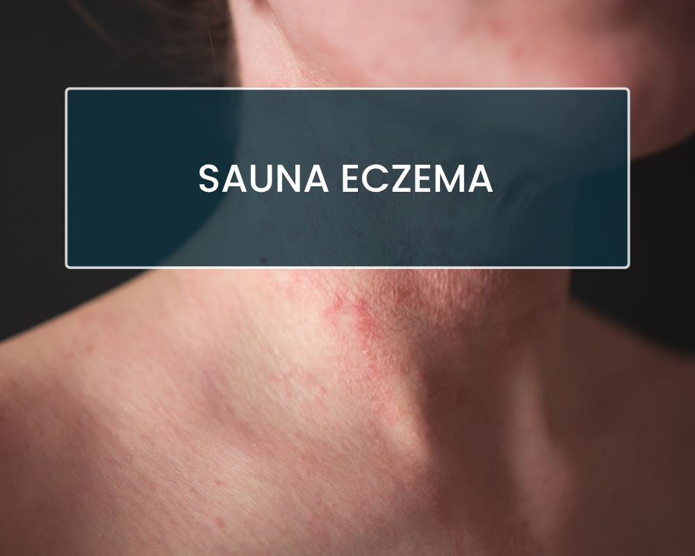 SAUNA ECZEMA: EVERYTHING YOU NEED TO KNOW
